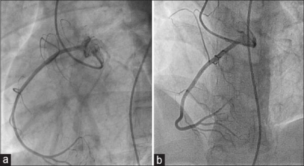 Coronary Angiogram - Blogs